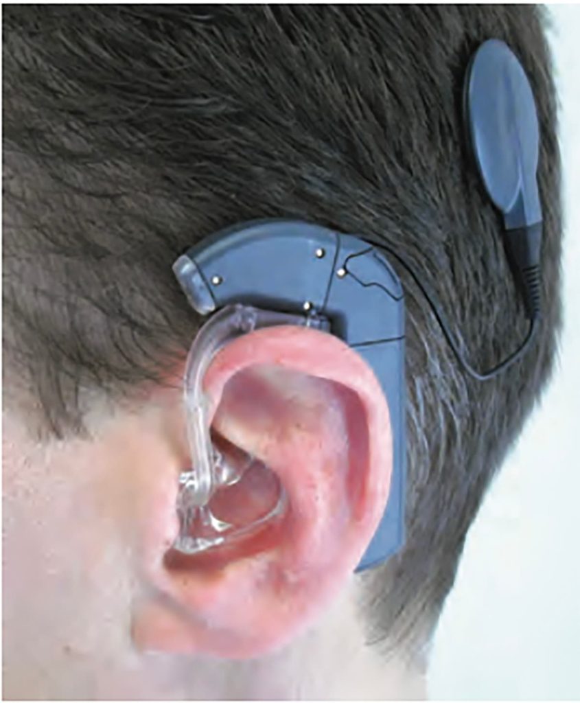 Cochlear Implant. CHHA Sudbury, ON
